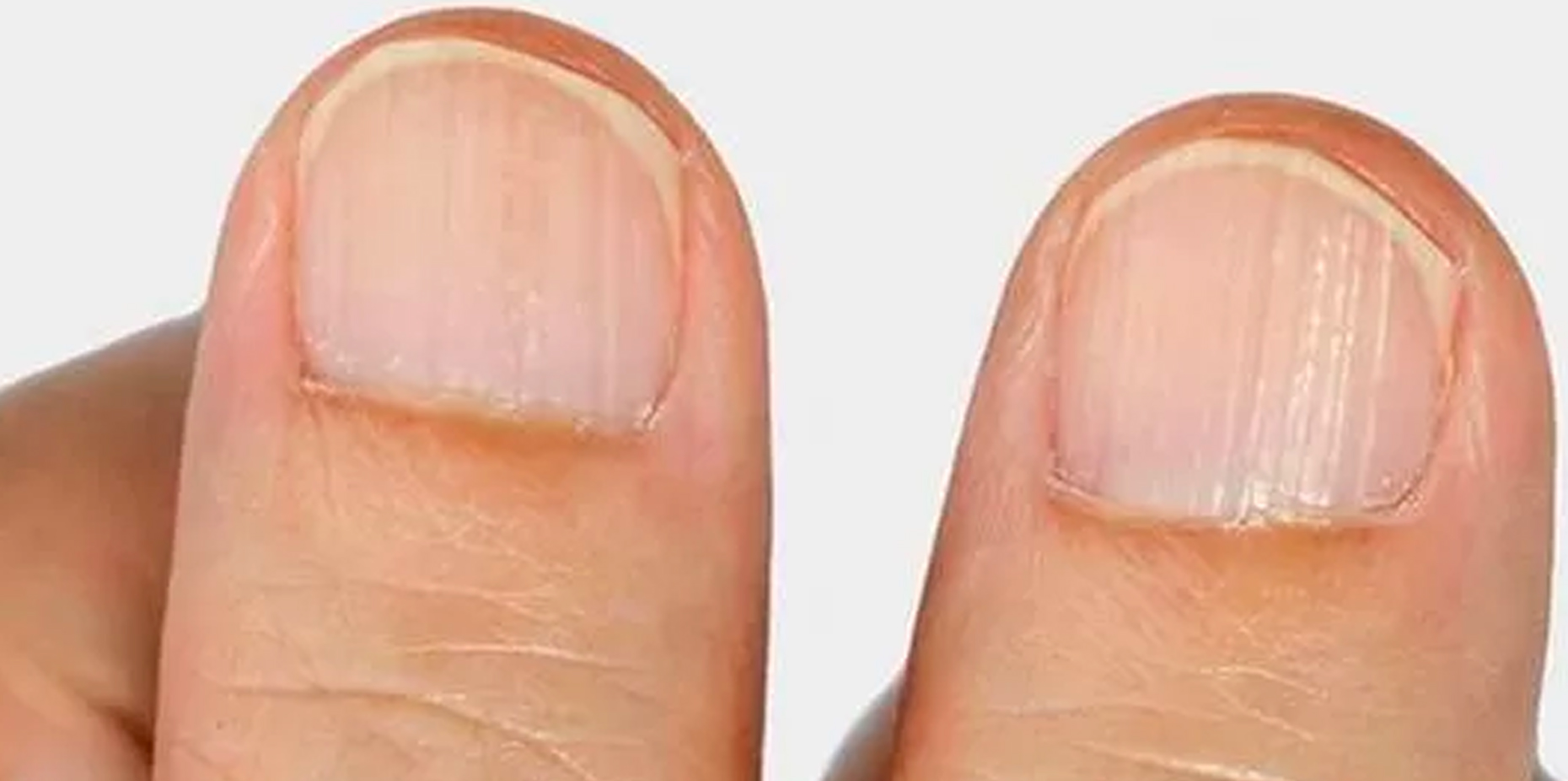 9 Signs And Symptoms Of Zinc Deficiency Health Normal